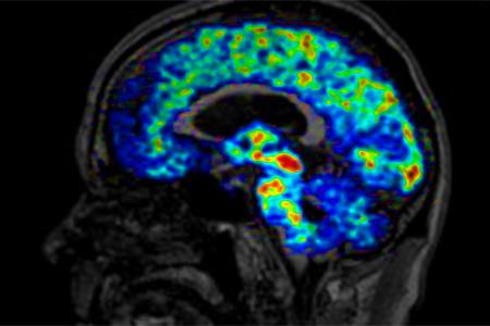 Johns Hopkins study of retired NFL players sheds light on concussion ...