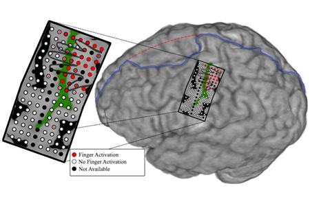 Man moves individual fingers on prosthetic arm using only his thoughts ...