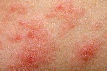 Dust mite insights may lead to tools to fight against allergies and ...