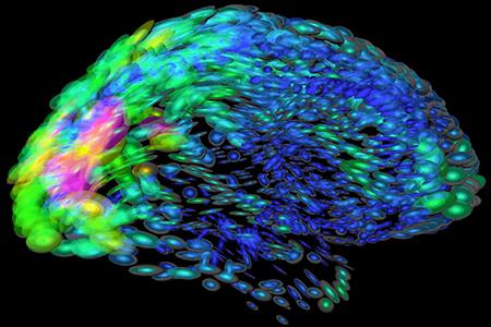 Brain inflammation a hallmark of autism, Johns Hopkins analysis shows | Hub