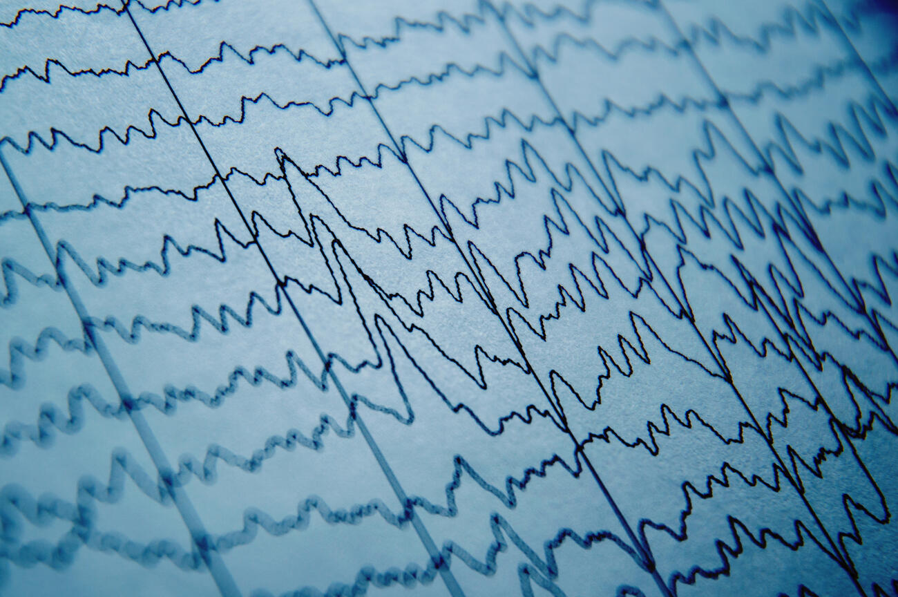 New epilepsy tool could cut misdiagnoses by nearly 70% using routine EEGs | Hub