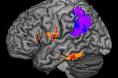 A closer look at what goes wrong in the brain when someone can't spell ...