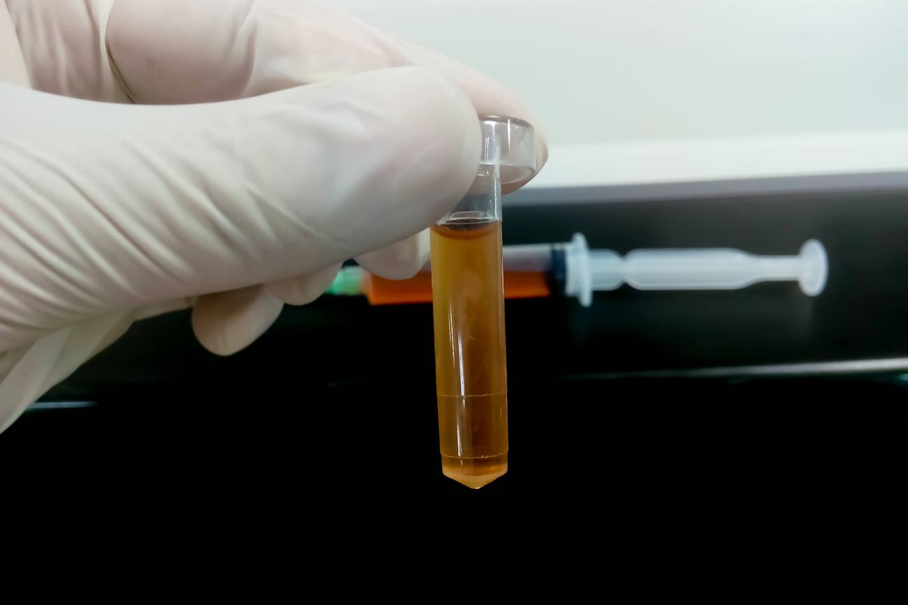 Cerebrospinal fluid may be able to identify aggressive brain tumors in ...