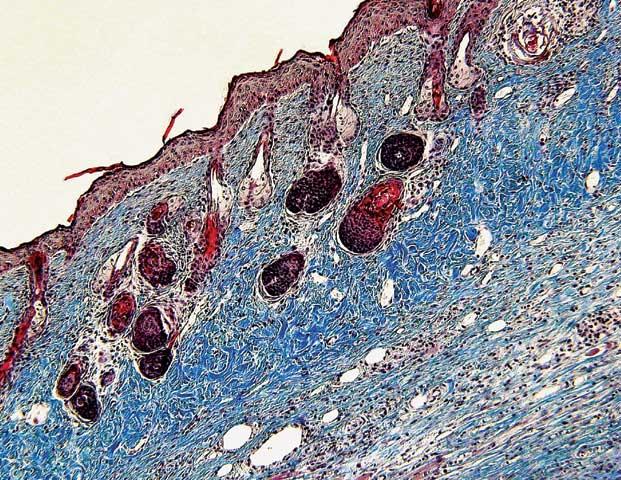 After burns, healthy skin? | Hub