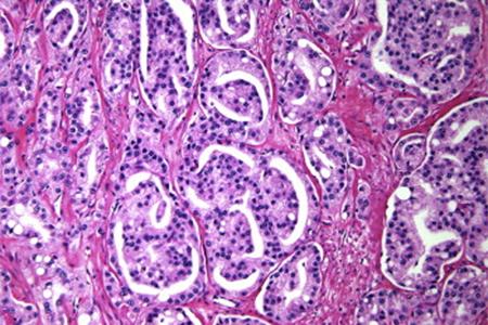 Simplified prostate cancer grading system deemed accurate, could reduce ...